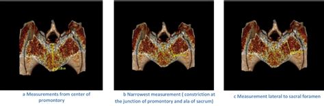 Sacral Dysmorphism And Gender Specific Variations A Ct Based Approach