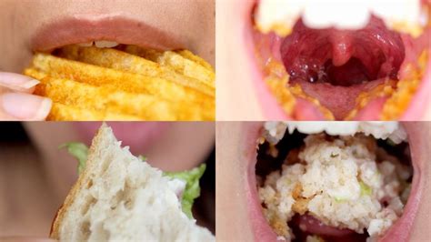 Sweet Maria Pharyngitis And A Tonsil Stone Sweet Maria