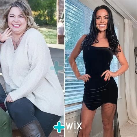 Gastric Sleeve Before And After Wix Clinic