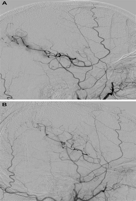 Occlusion Of Extracranial Intracranial Bypass Anastomosis As