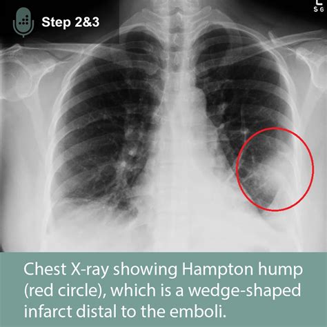 Pulmonary Embolism Hampton Hump A Classic Pulmonary Embolism