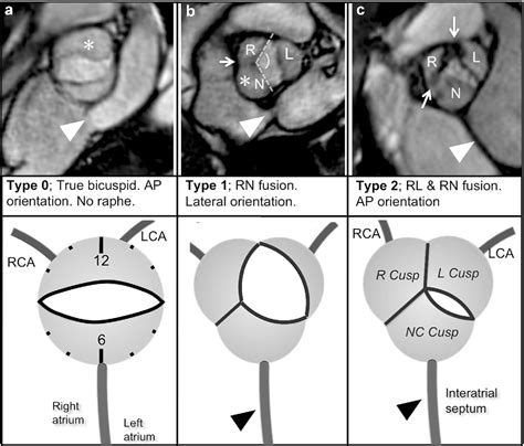 X Valve Aortic