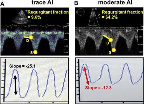 Figure 1 From Estimation Of The Severity Of Aortic Insufficiency By Hvad Flow Waveform