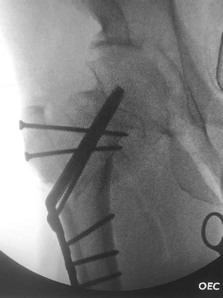 16 Year Old Boy With Post Perthes Deformity Cllc Montréal Dre Marie