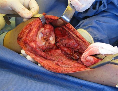 Partial Tibia Prosthesis Oncosurgery