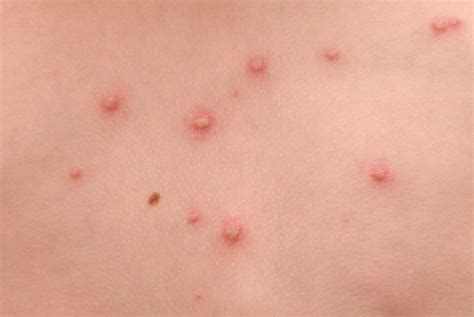 10 Types Of Skin Bumps Health And Detox And Vitamins