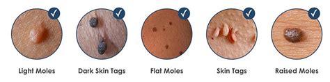 Skin Tag Spot Treatment Patch