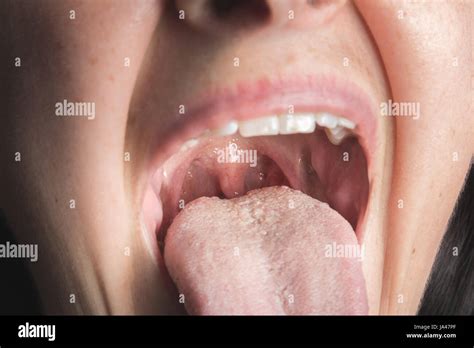 What Happens If Your Uvula Is Touching Your Tongue
