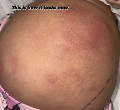 Cellulitis After Filler R Botchedsurgeries