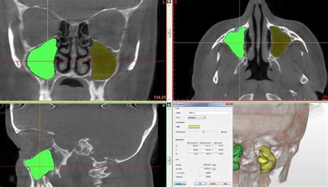 Segmentation And Three Dimensional Configuration Of Maxillary Sinus Download Scientific Diagram