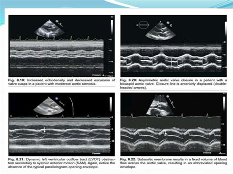 M Mode Echo 1 1 Pptx