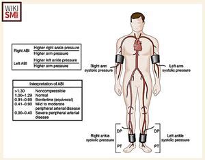 Ankle Brachial Index Abi Wikism Sports Medicine Wiki