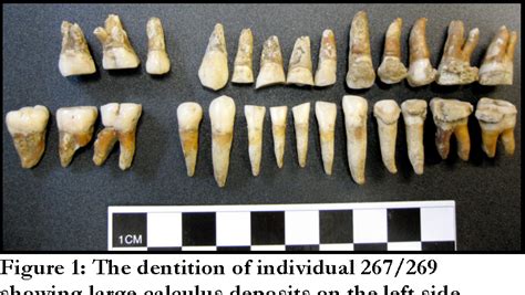 Dental Calculus Archaeology Dental Calculus Archaeology