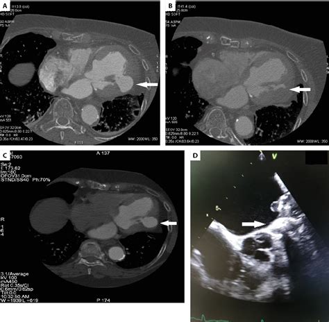 An Unusual Long Term Follow Up Of A Patient With A Left Ventricular