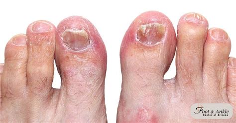 How To Get Rid Of A Toe Infection Expert Guide