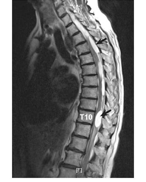 Pre Operative Mid Sagittal Thoracic Mri Identifying Loculated Cystic
