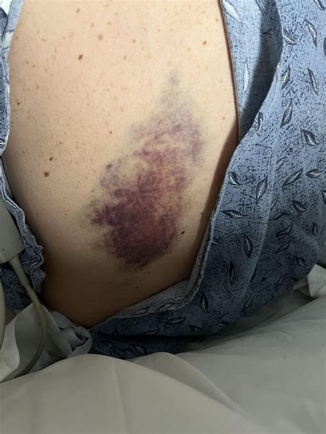 Post Surgery Bruise On Back Rbruises