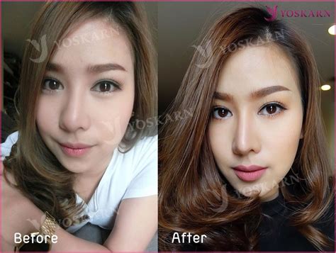 Cosmetic Surgery Thailand Best Plastic Surgery Before And After