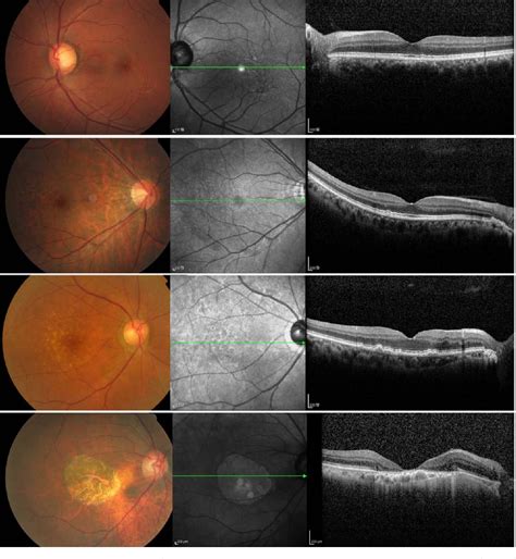 Figure 1 From Correlation Between Subfoveal Choroidal Thickness And The Severity Or Progression