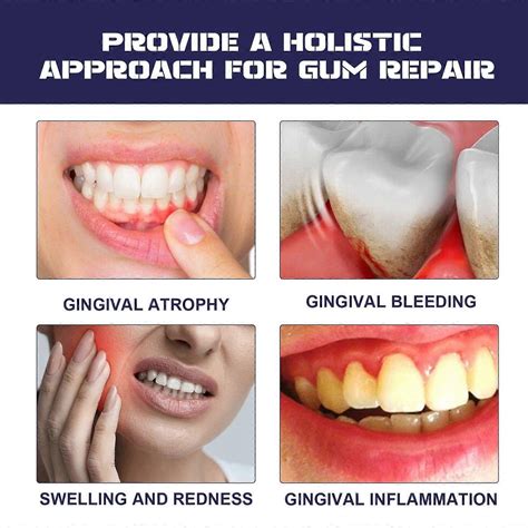 Tooth Repair Gel Relieves Blistering Mouth And Gum Fire Cleans Tartar