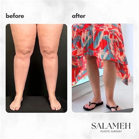 Understanding Lipedema Legs Causes Symptoms And Treatment Salameh