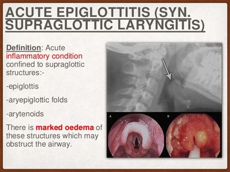 Acute Epiglottits Ppt
