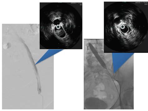 Case Report Single Setting Treatment For Iliac Dvt Endovascular Today