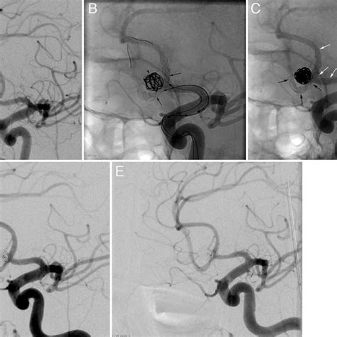 Occlusion Process Of Right Mca Bifurcation Aneurysm A And B