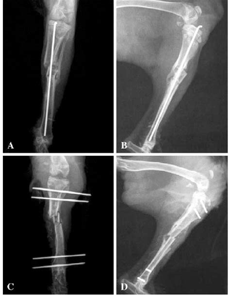A Frontal Radiogram Of The Right Leg The Double Tibial Osteotomy Was