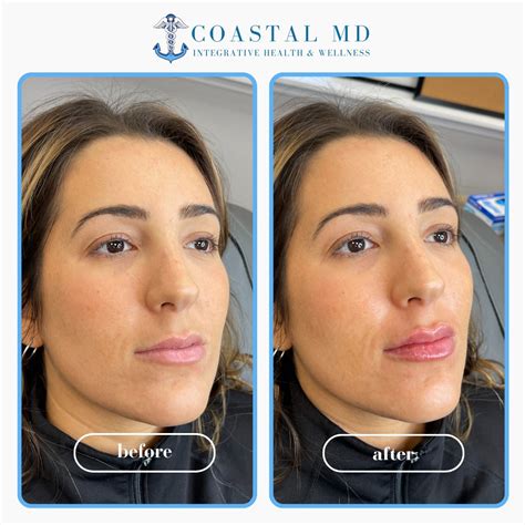 Coastal Md 💋 Lip Filler Transformation 💋 Achieve Fuller More