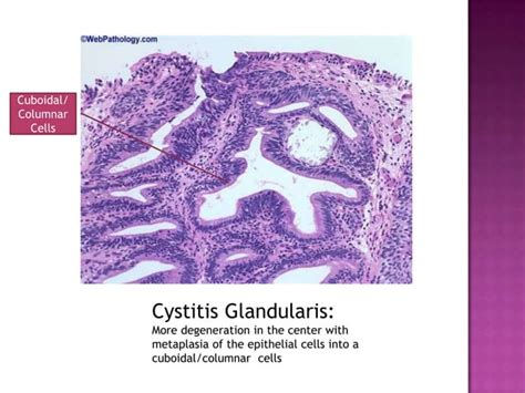 Cystitis Cystica And Glandularis Pptx