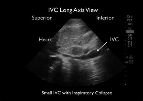 Caval Sonography In Shock Seif 2012 Journal Of Ultrasound In