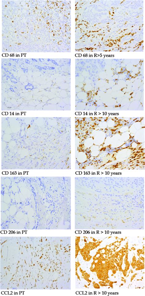 Ihc Showing The Expression Of Dc68 Cd14 Cd163 Cd206 And Ccl2 In Pts Download Scientific