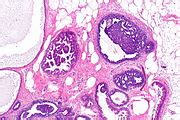 Florid Epithelial Hyperplasia Libre Pathology