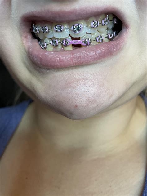 Braces Progress 6 Weeks In R Braces