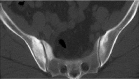 Sijs With Dense Homogenous Sclerosis Of Iliac And Sacral Bones And No