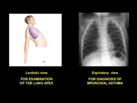 Basic Chest X Ray Interpretation