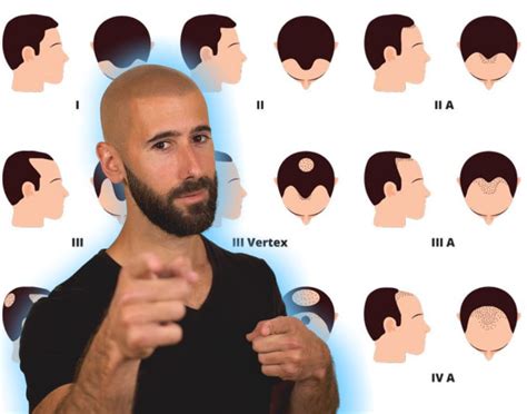 Scale And Hair Loss At Edward Varley Blog