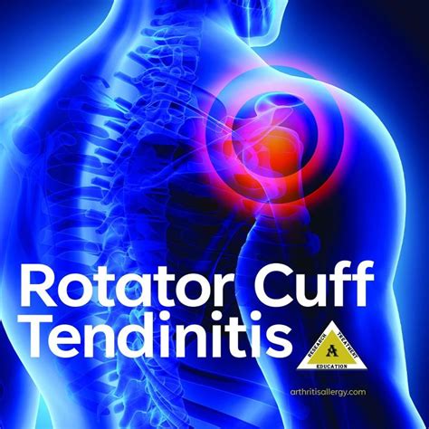 Treatment For Rotator Cuff Tendinitis Shoulder Pain Arthritis