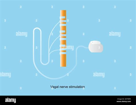 Medical Illustration Of Vagal Nerve Stimulation Vns Device And Its