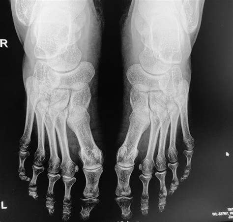 Does The X Ray Show Osteopenia R Xrays