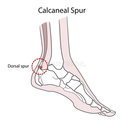 Posterior Calcaneal Spur