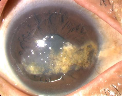 Gelatinous Drop Like Corneal Dystrophy
