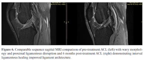Acl Ruptured All You Need To Know Centeno Schultz Clinic