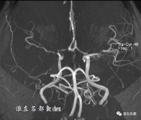 神经血管影像速阅47：管壁mri—sle血管炎和烟雾综合征 脑医汇
