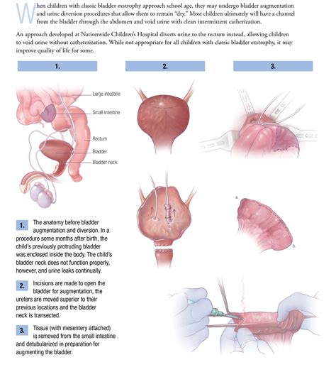 A New Kind Of Rectal Diversion In Classic Bladder Exstrophy