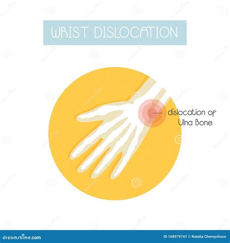 Finger Dislocation Human Medical Organ Vector Illustratio