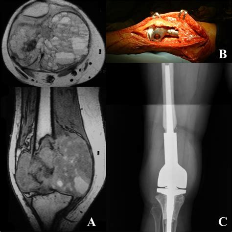 A 19 Year Old Patient With Giant Aggressive Distal Femoral Cbl Download Scientific Diagram