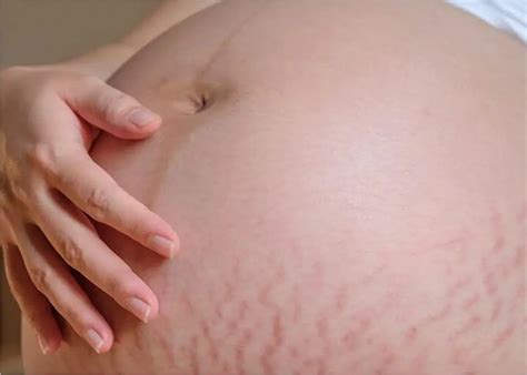 Whatarepregnancystretchmarkscausesandtreatments1081x772crop