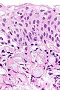 Signet Ring Cell Carcinoma Libre Pathology